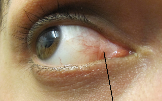 PLICA SEMILUNARIS, tin tức Mới nhất Khu vực màu đỏ bí ẩn trong mắt ...