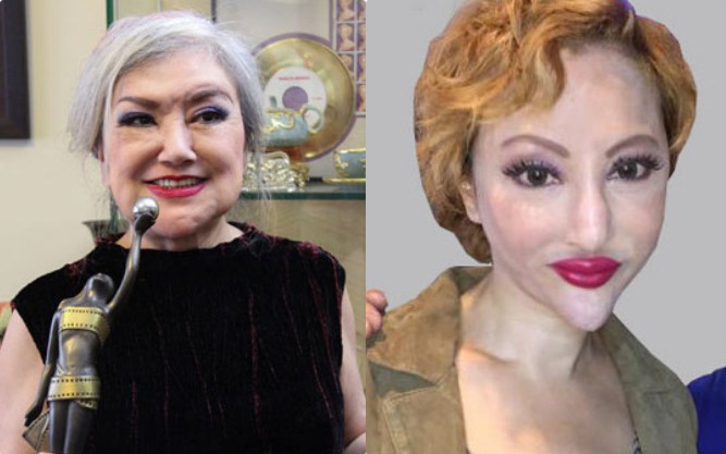 RUMI KANDA, tin tức Mới nhất Những ca phẫu thuật thẩm mỹ thất bại của ...