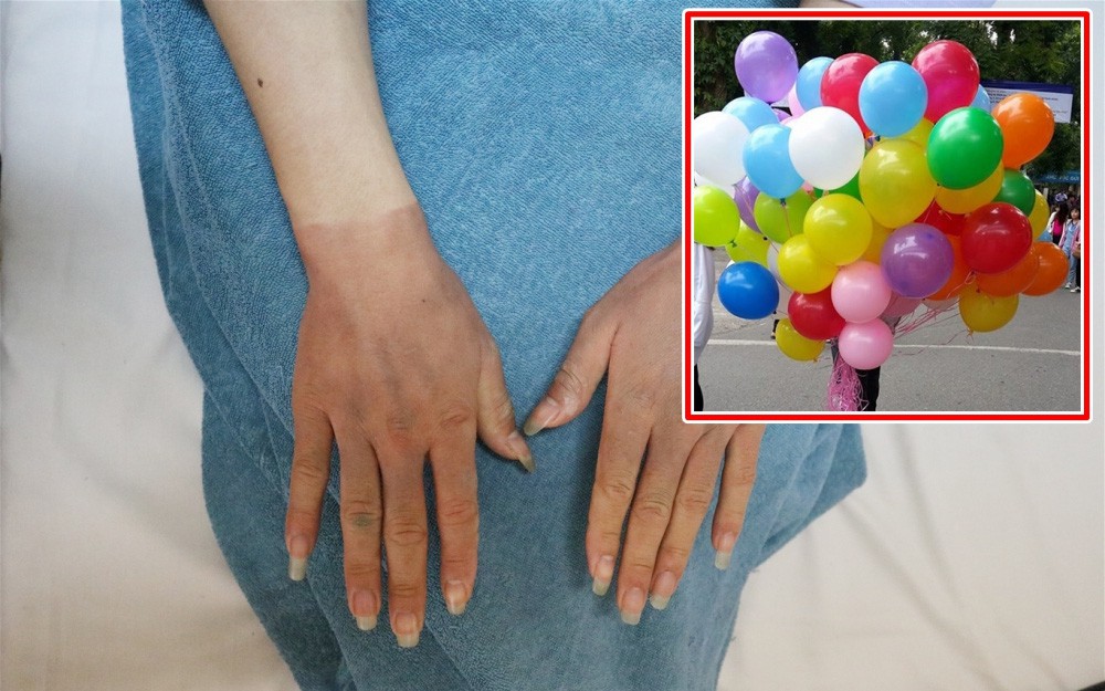 BỎNG KHÍ HYDRO, tin tức Mới nhất 4 người đàn ông nhập viện khẩn cấp do ...