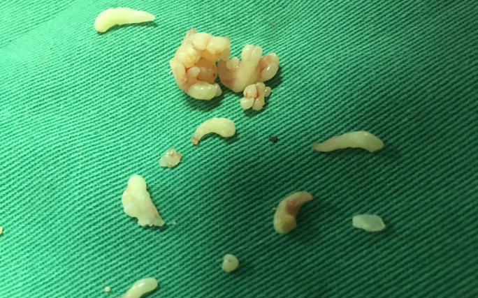 KHỐI U RĂNG, tin tức Mới nhất Lấy gần 20 chiếc răng cho bé 12 tuổi bị ...