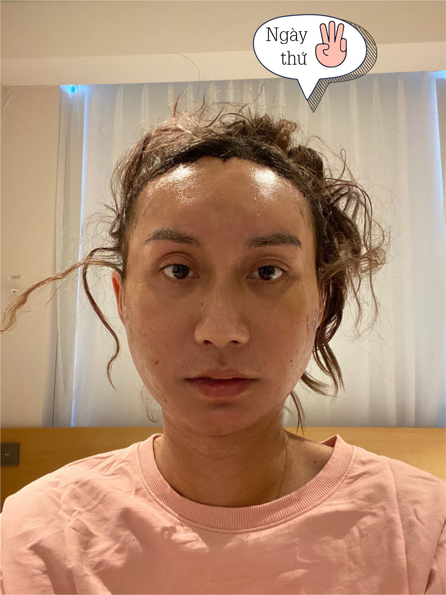 Lynk Lee công khai quá trình chuyển giới 2 lần đại phẫu