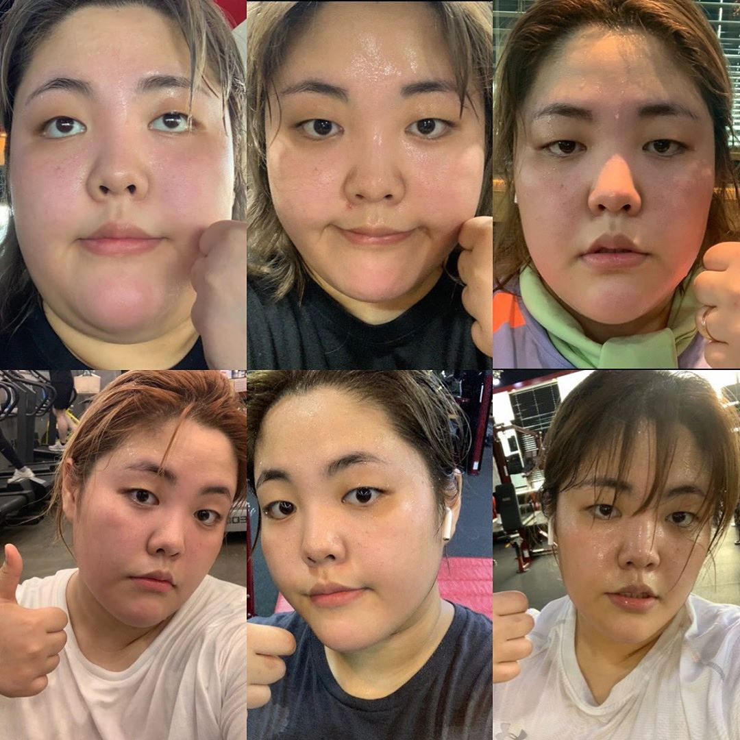 "Thánh ăn" Yang Soobin mất giọng sau phẫu thuật ung thư tuyến giáp