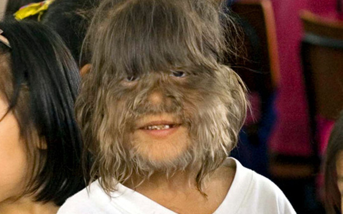 SUPATRA SASUPHAN, tin tức Mới nhất Cô bé “người sói” từng nổi tiếng thế ...