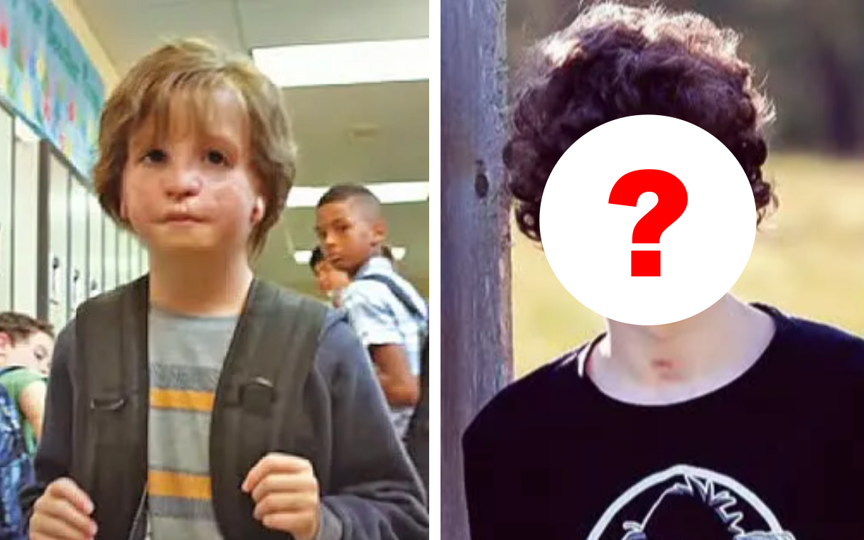 BỆNH TREACHER COLLINS, tin tức Mới nhất Từ nhỏ đã bị xa lánh, gọi là ...