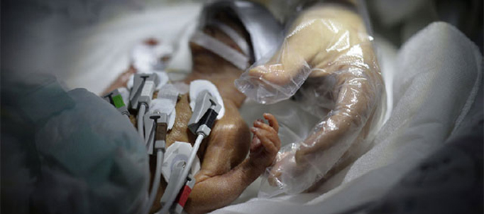 Em bé tí hon chỉ dài bằng chiếc đũa và nặng 660gr - EM BÉ TÍ HON, EM ...