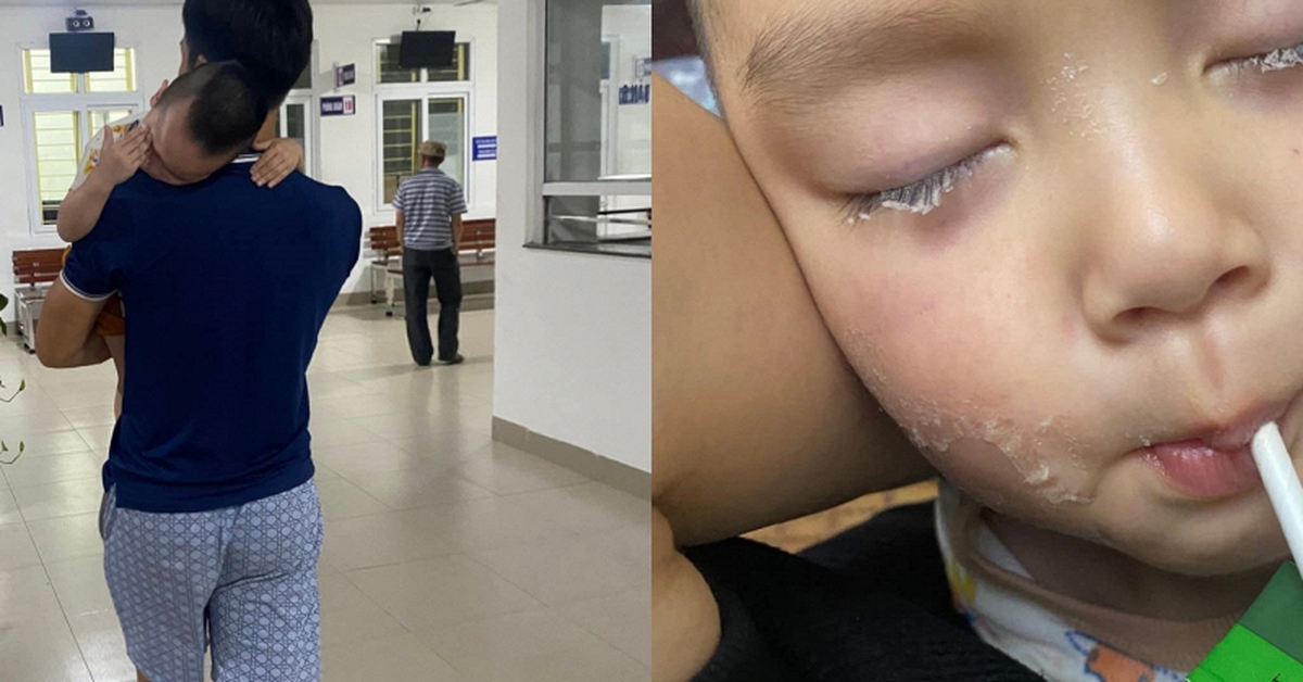 Lại thêm 1 em bé bị keo 502 dính vào mắt