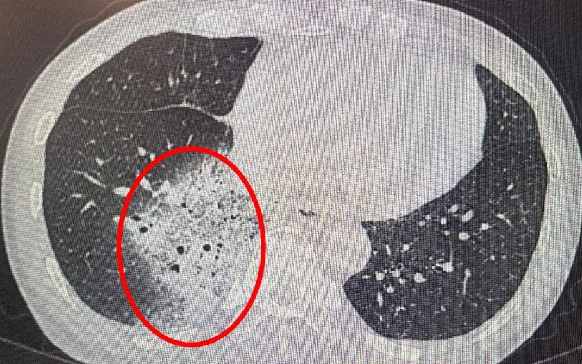 VIÊM PHỔI LEGIONNAIRES: tin tức Mới nhất Người phụ nữ phổi trắng xóa vì ...
